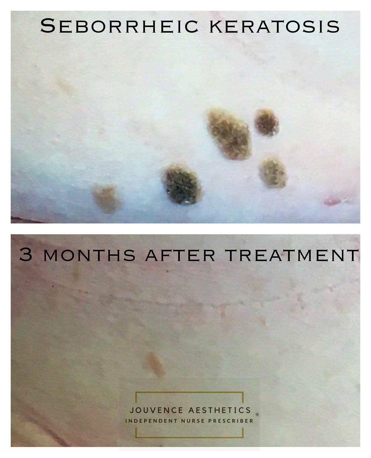 Seborrhoeic keratosis/wart removal at Cheshire Lasers, Middlewich