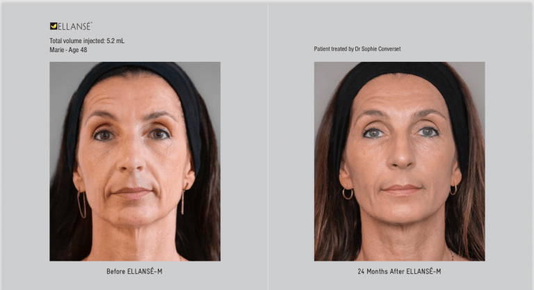 Ellansé Treatments by Dr Teri Johnson in Cheshire