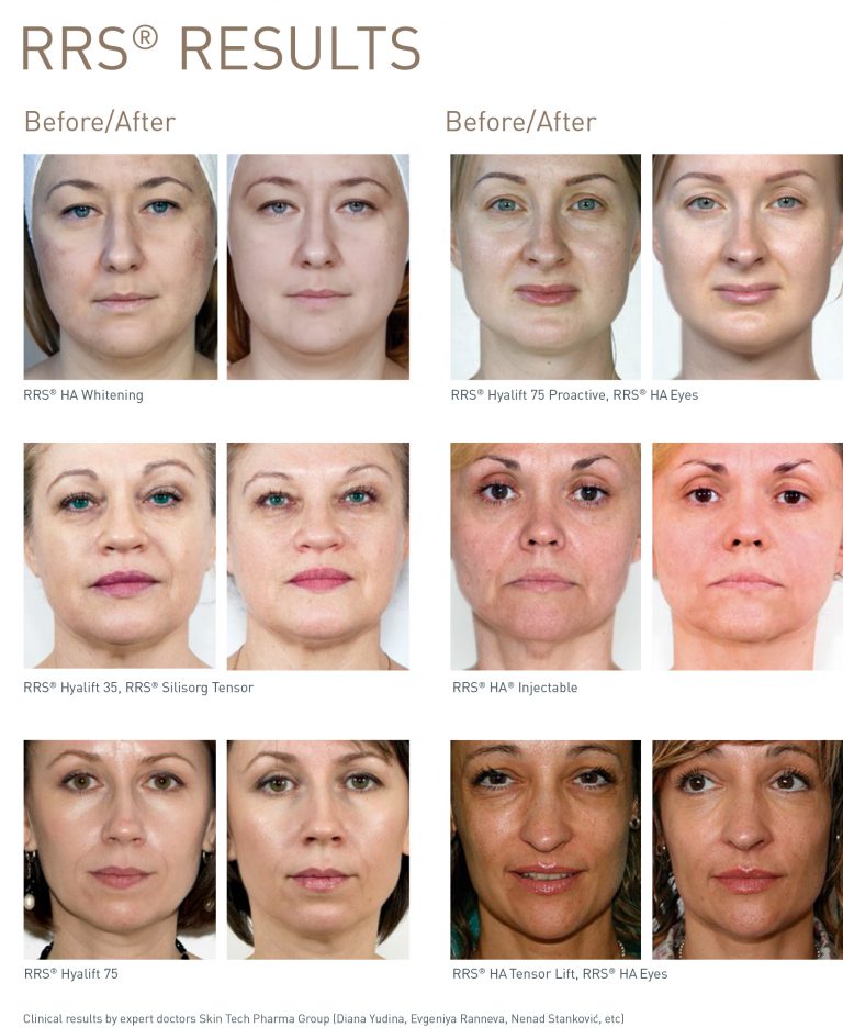 RRS Mesotherapy at Cheshire Lasers, Middlewich.