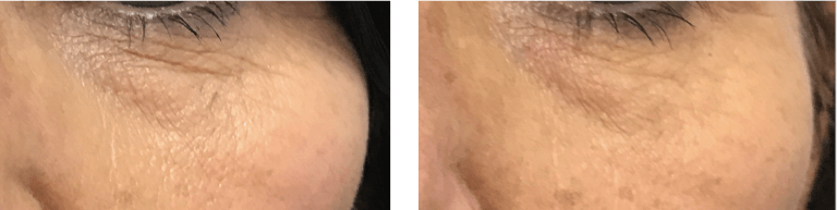 Cheshire Lasers Ultraformer Wrinkle Treatment Before and Afters