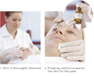 Agera Rx skin peels at Cheshire Lasers Clinic Middlewich.