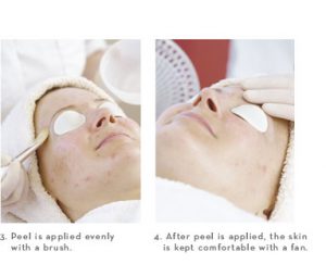 Agera Rx skin peels at Cheshire Lasers Clinic Middlewich.