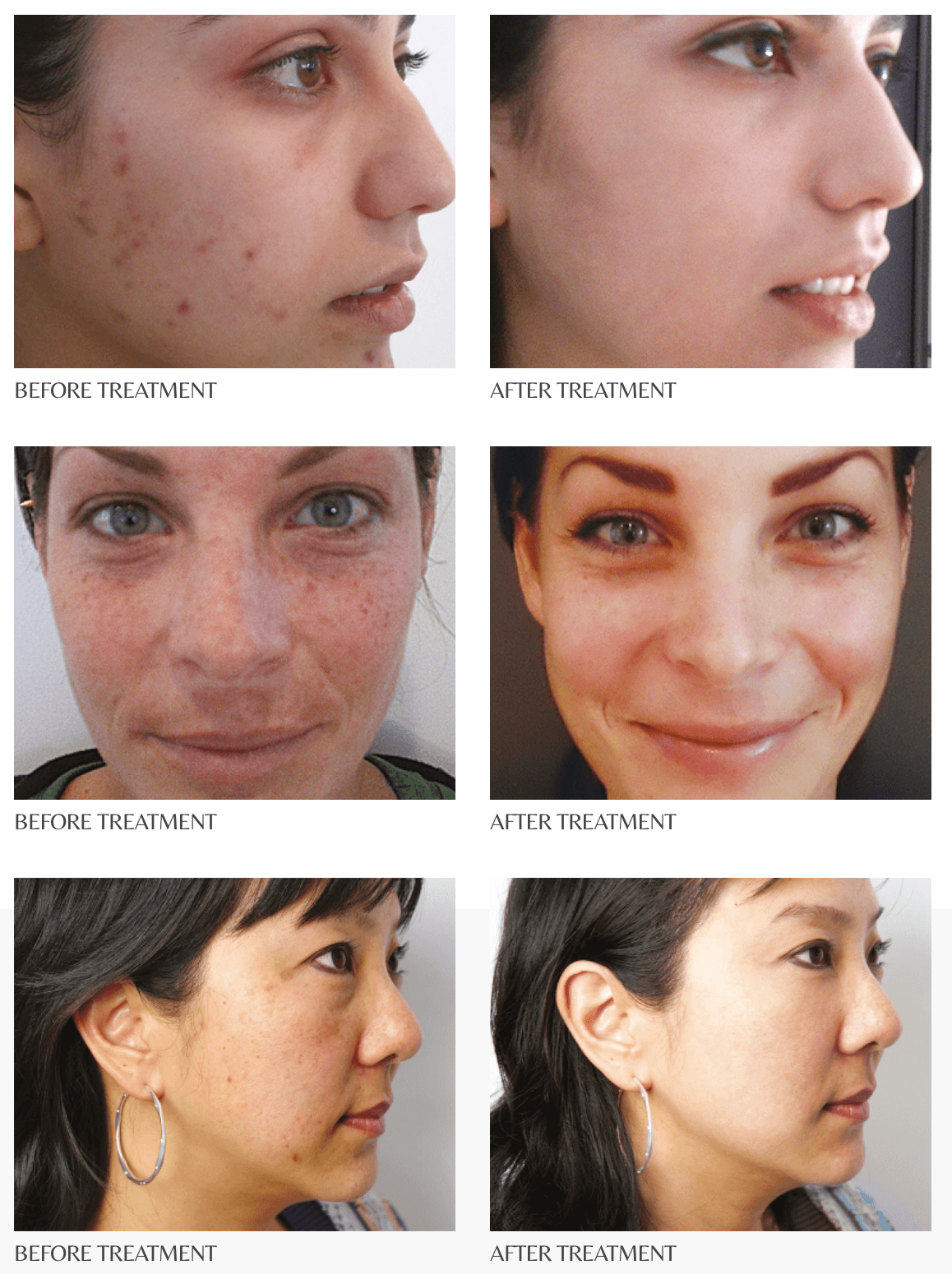 The Perfect Peel Treatment is now at Cheshire Lasers Clinic Middlewich