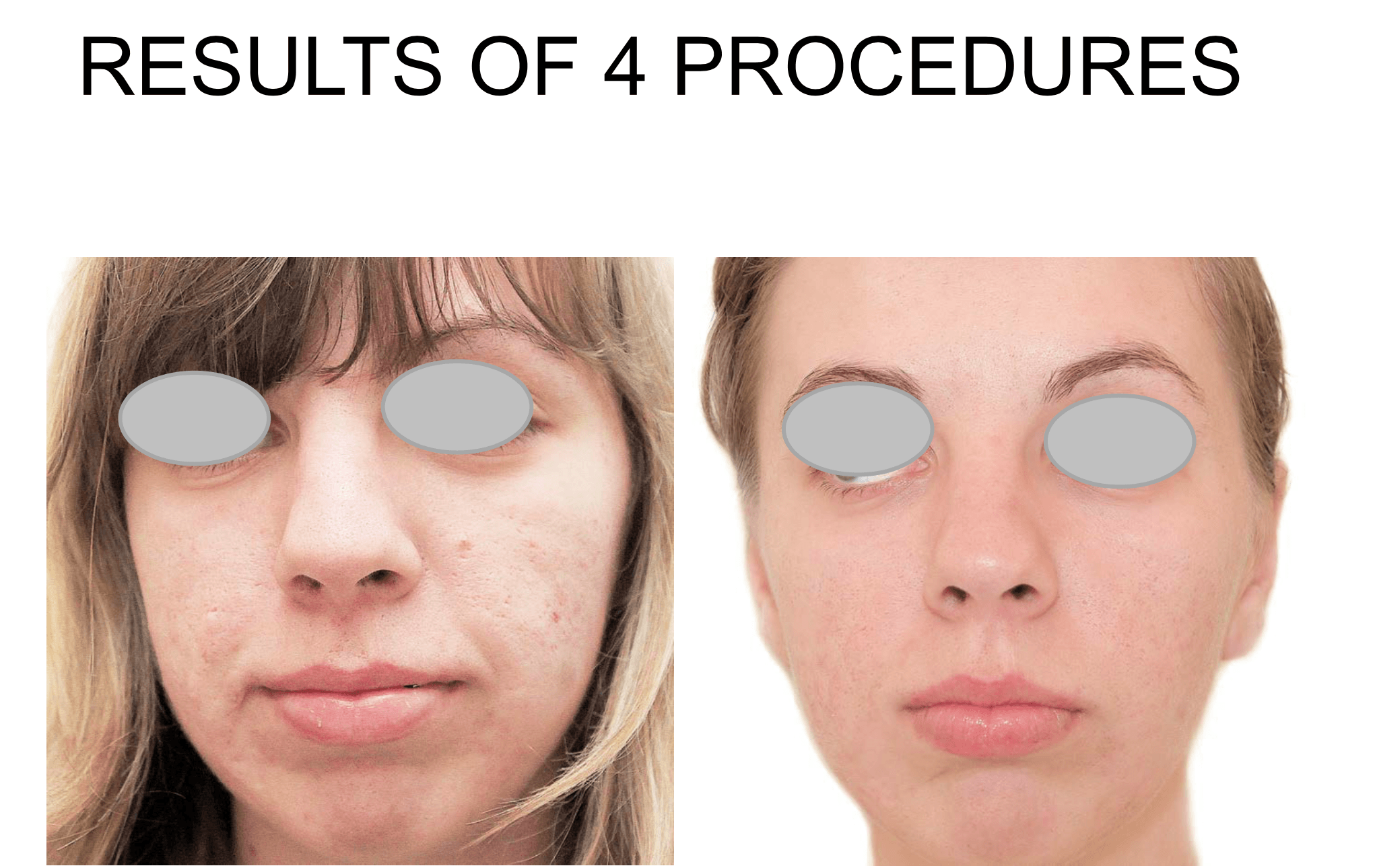 Xela Rederm Redermalization at Cheshire Lasers, Middlewich.