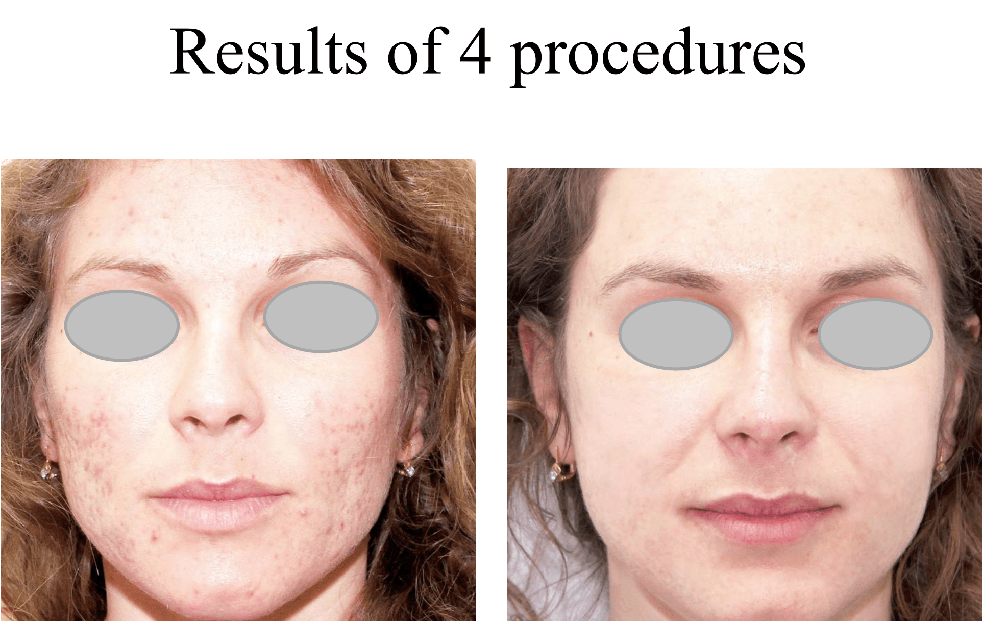 Xela Rederm Redermalization at Cheshire Lasers, Middlewich.