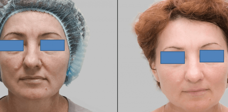 Xela Rederm Redermalization at Cheshire Lasers, Middlewich.