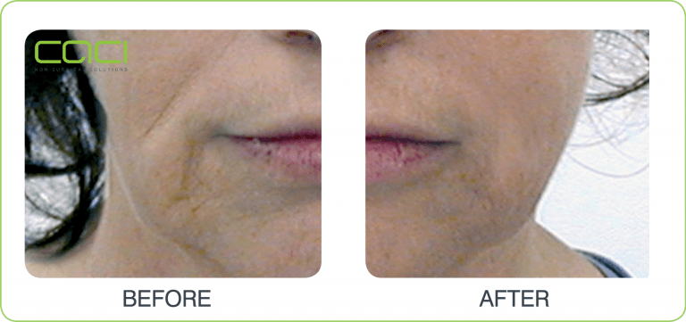 View some CACI Treatment before and ater images