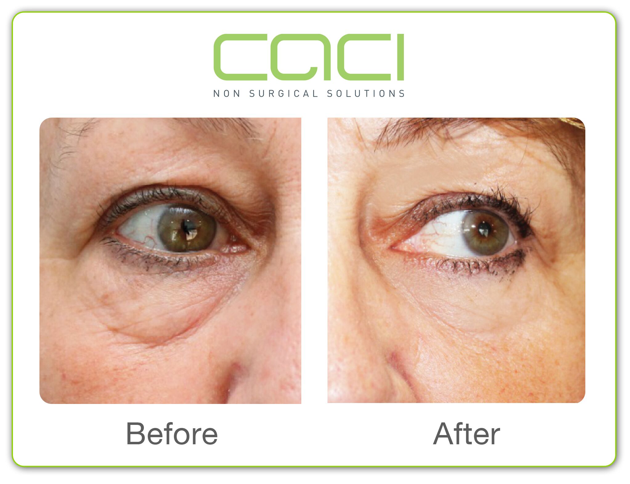 View some CACI Treatment before and ater images