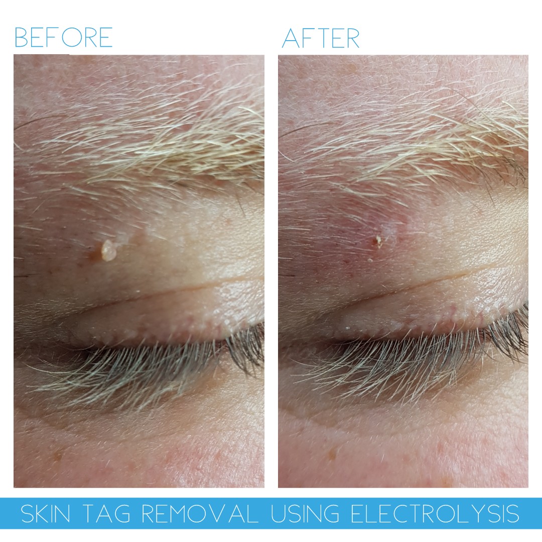 Advanced Electrolysis at Cheshire Lasers, Middlewich.
