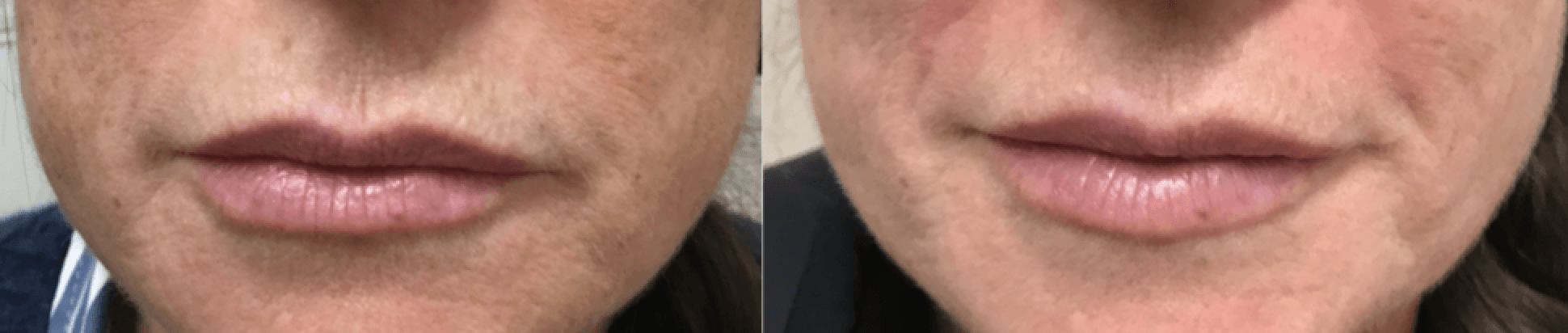 Treatments for Lip lines / perioral area