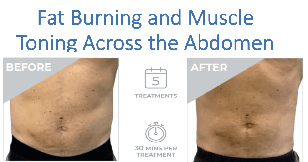 Powersculpt Muscle Treatment - Cheshire Lasers