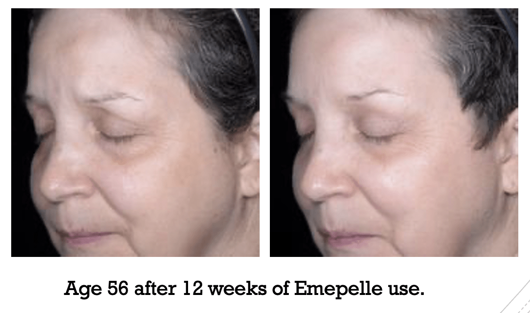 Menopausal Skin Rejuvenation: Finding A Solution With Emepelle