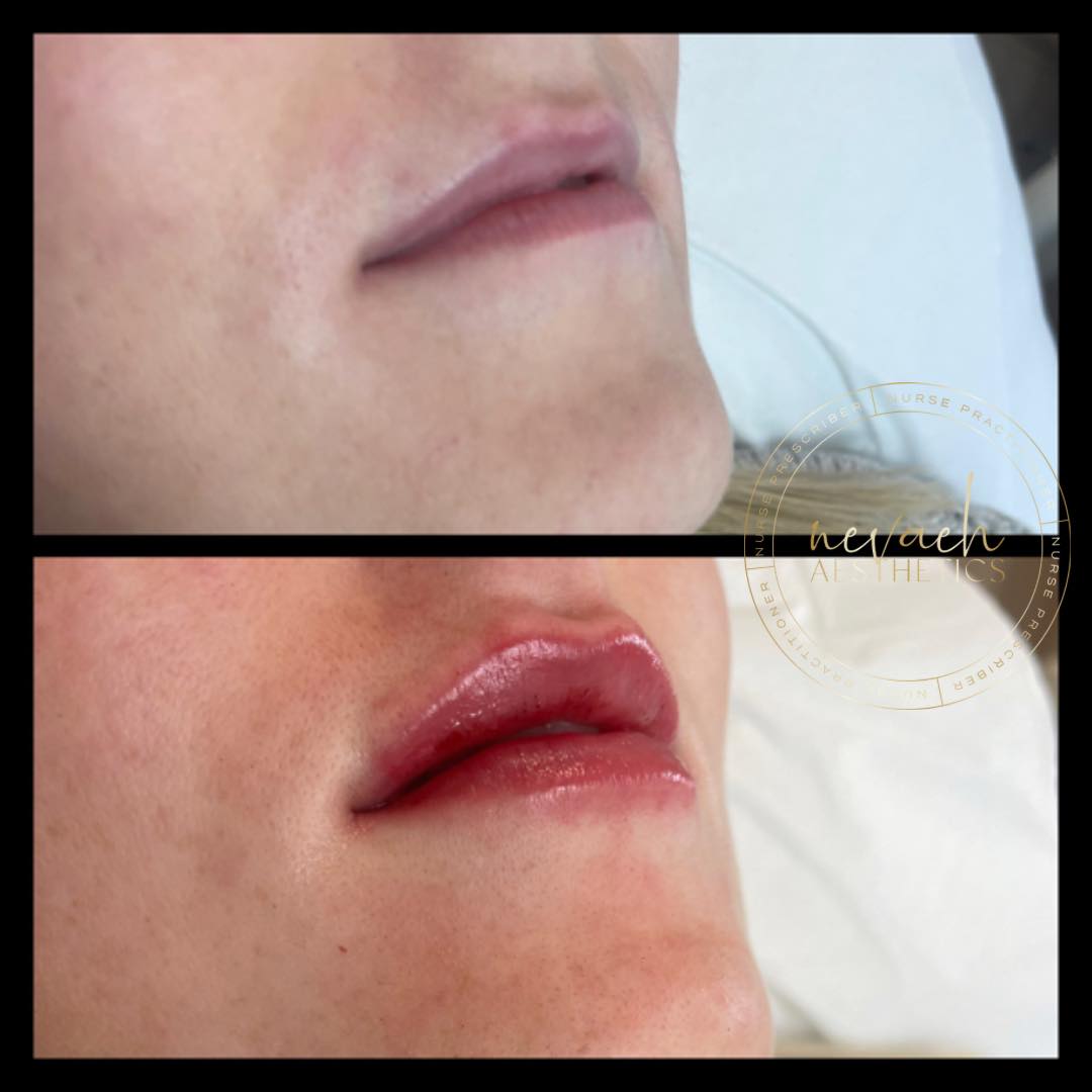 Lip Filler, Lip Botox Flip, Lip Rejuvenation at Cheshire Lasers