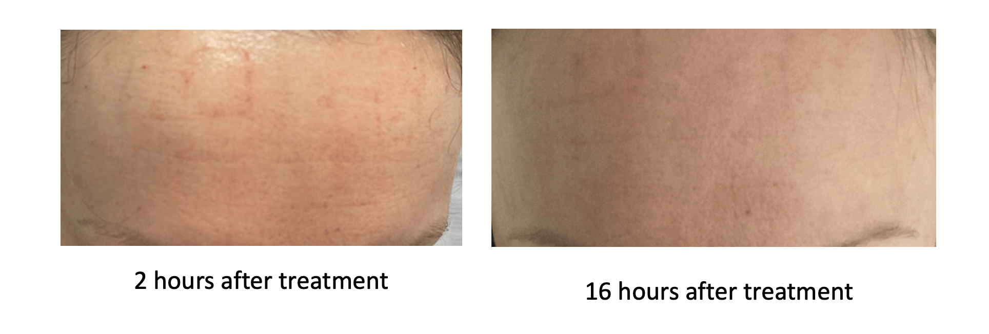 RadioFrequency RF Microneedling at Cheshire Lasers
