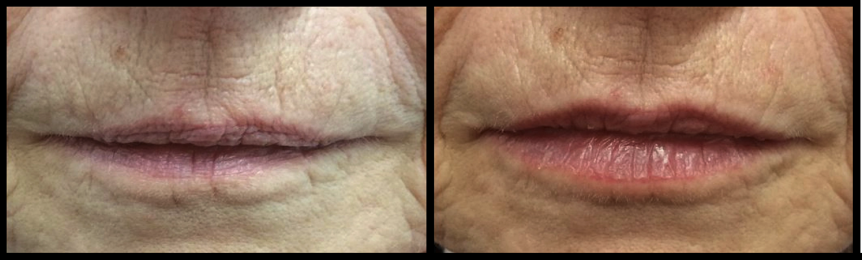 Lip Filler, Lip Botox Flip, Lip Rejuvenation at Cheshire Lasers