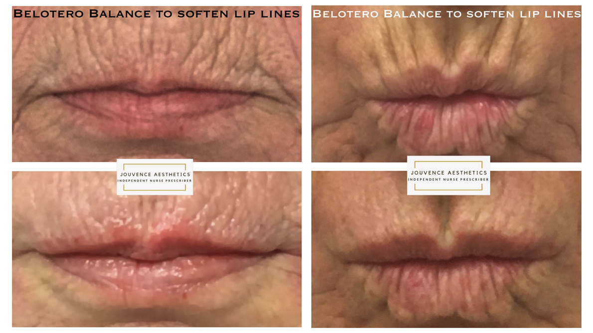 Lip Filler, Lip Botox Flip, Lip Rejuvenation at Cheshire Lasers
