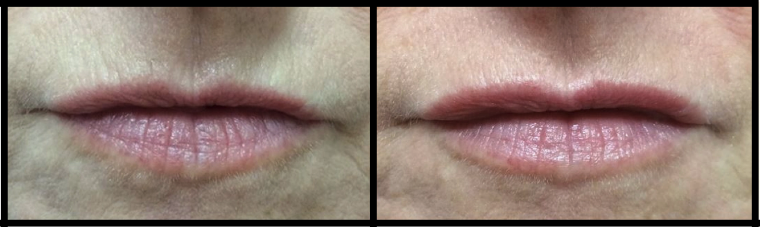 Lip Filler, Lip Botox Flip, Lip Rejuvenation at Cheshire Lasers