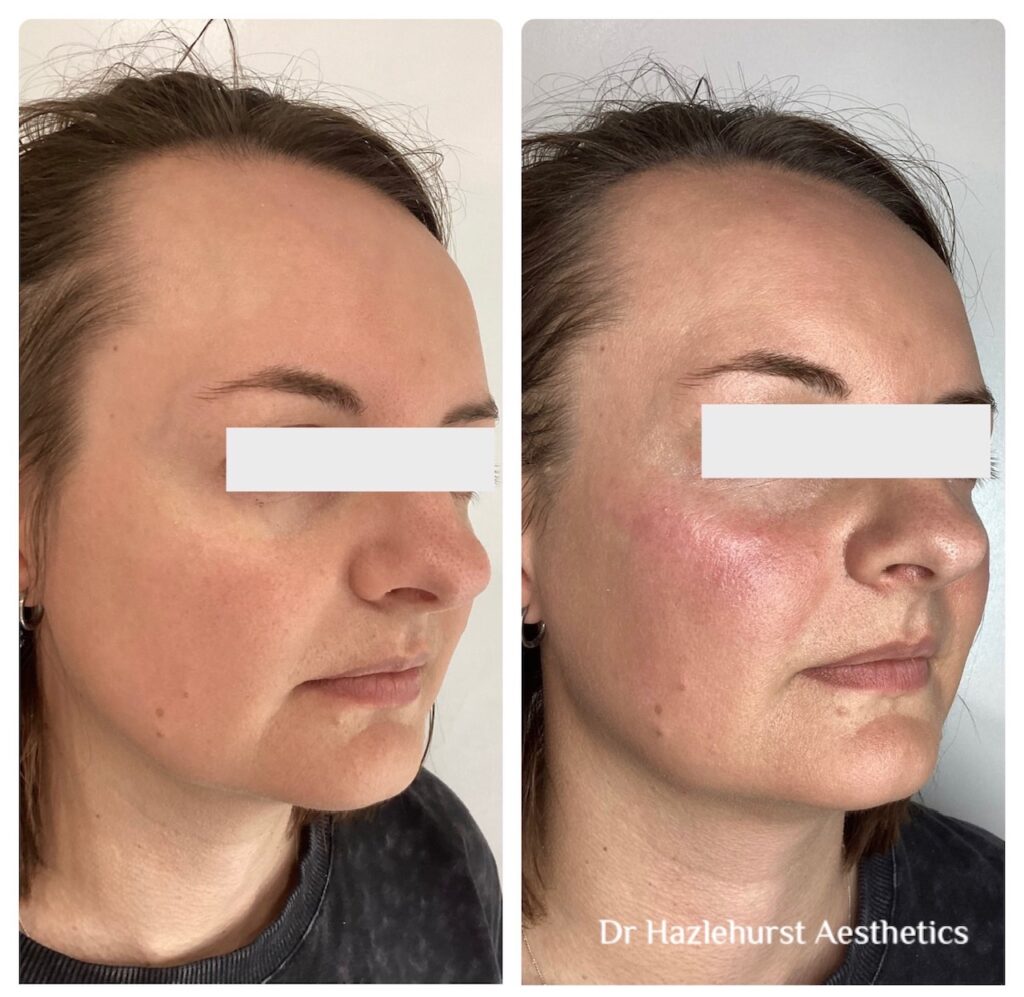 Discover the Benefits of Stylage Dermal Fillers at Cheshire Lasers