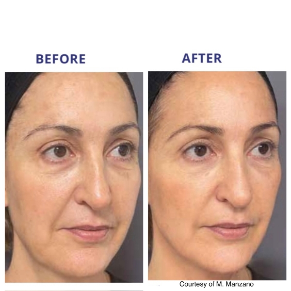 Achieve a Lifting Effect with Profhilo Structura at Cheshire Lasers