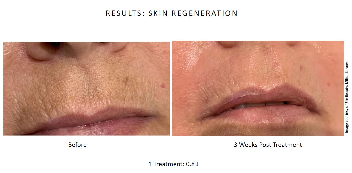View Neogen Plasma Treatment Before and Afters