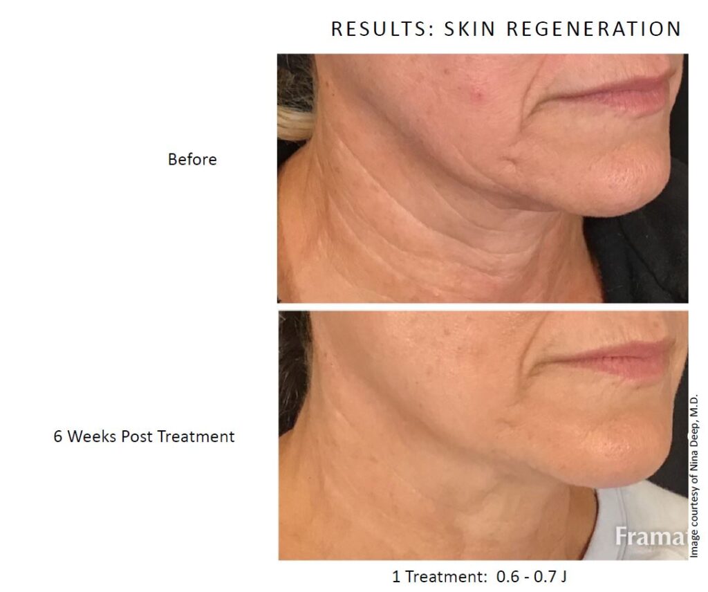 View Neogen Plasma Treatment Before and Afters