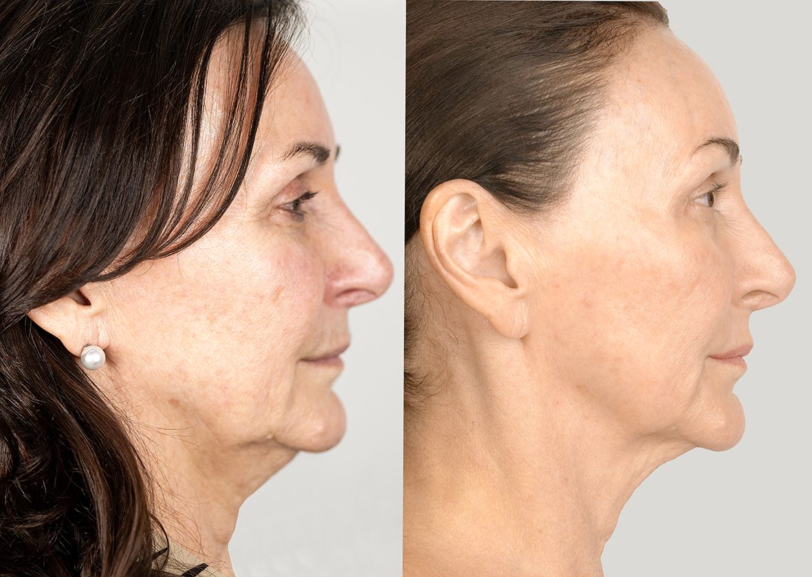 View Neogen Plasma Treatment Before and Afters