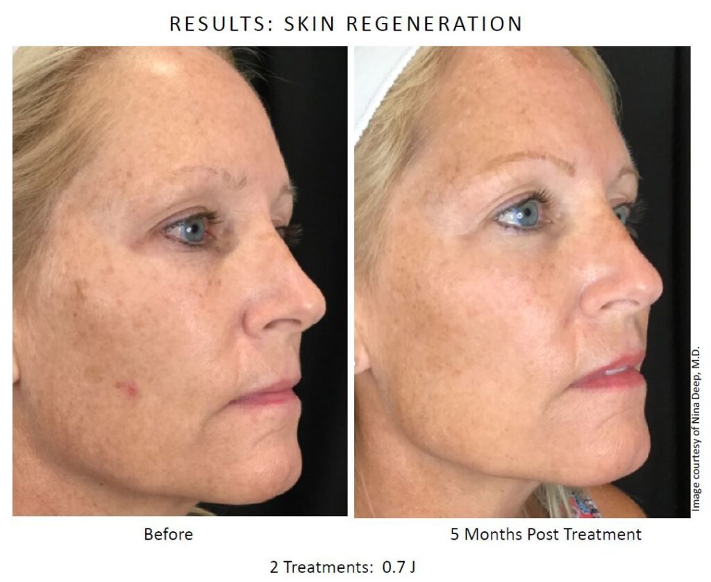View Neogen Plasma Treatment Before and Afters
