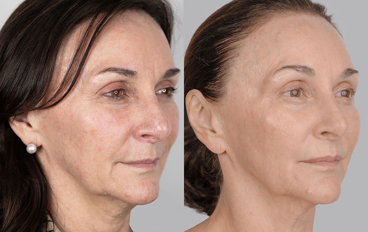 View Neogen Plasma Treatment Before and Afters